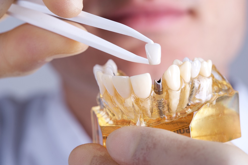 How Much Do Dental Implants Cost In Canada Vellore Woods Dentistry How Much Do Dental Implants Cost In Canada Vellore Woods Dentistry